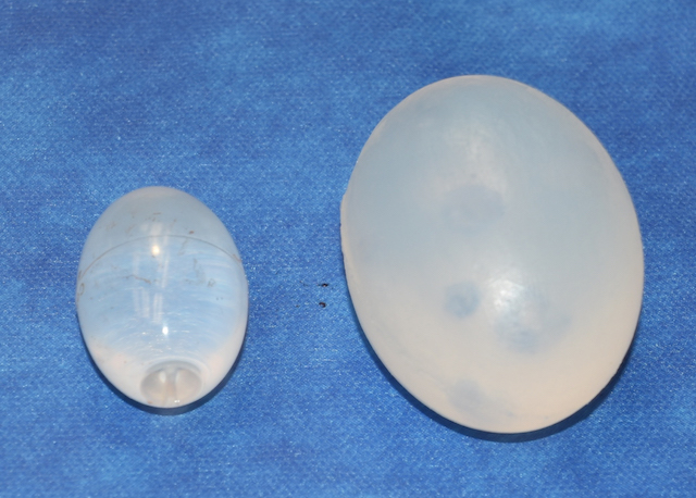 Plastic Surgery Case Study - XL Testicle Implants in Penile-Scrotal ...