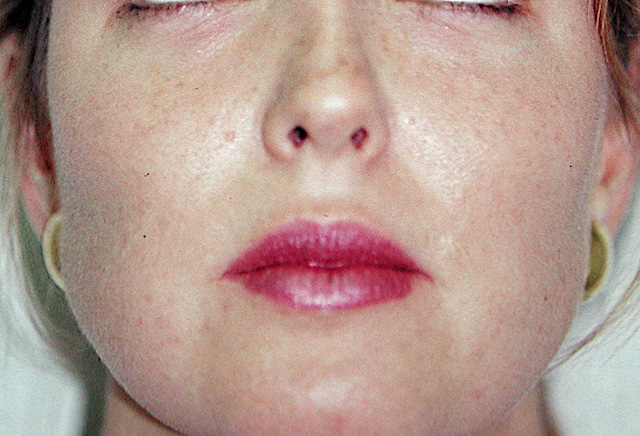 buccal lipectomy after submental view Dr Barry Eppley Indianapolis ...