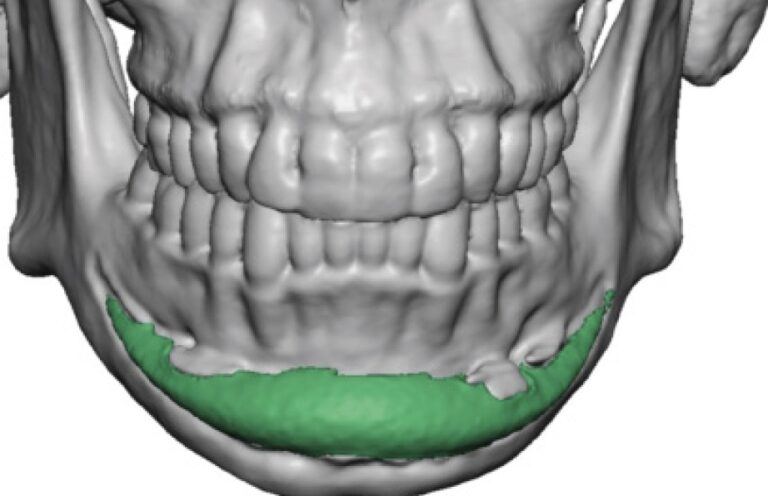 Long Term 3D CT Scan Study Of Chin Implant Bone Resorption - Explore ...