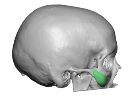 Plastic Surgery Case Study - Custom Forehead Implant with Temporal ...
