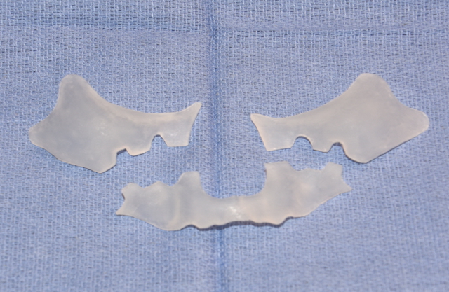 Plastic Surgery Case Study - The Custom Midface Mask Implant for ...