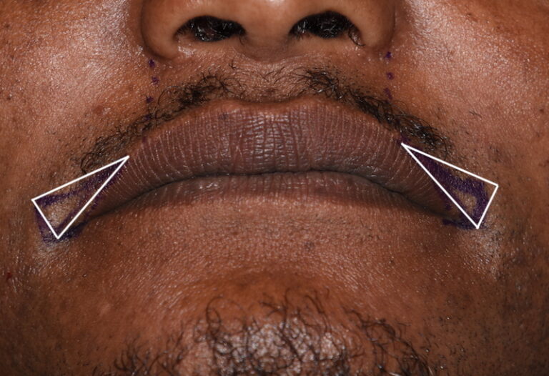 Plastic Surgery Case Study - The Extended Mouth Corner Lift for a ...