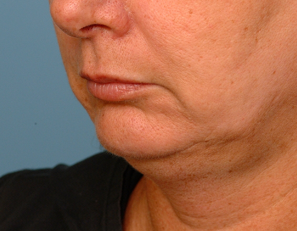 Plastic Surgery Case Study - The Synergestic Effects of Chin ...