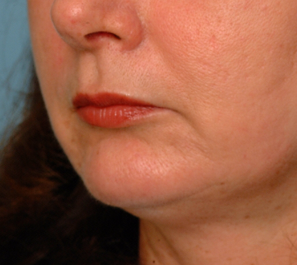 Plastic Surgery Case Study - The Synergestic Effects of Chin ...