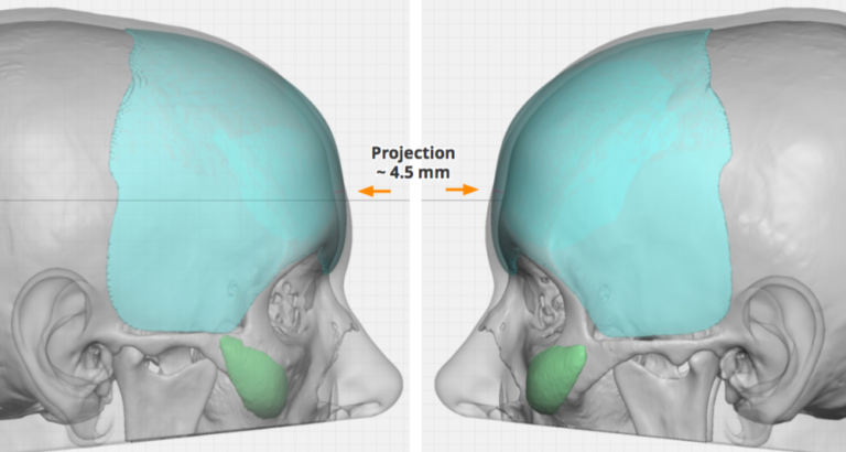Plastic Surgery Case Study - Custom Forehead Implant with Temporal ...