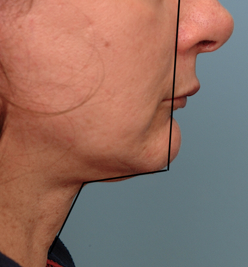 Plastic Surgery Case Study - The Synergestic Effects of Chin ...
