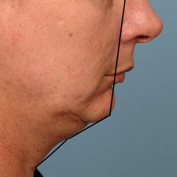 chin augmentation Archives - Explore Plastic Surgery