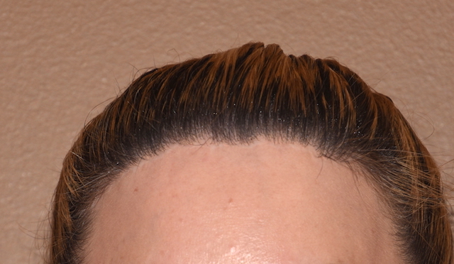 Scar Appearances After Frontal Hairline Advancement for Vertical ...