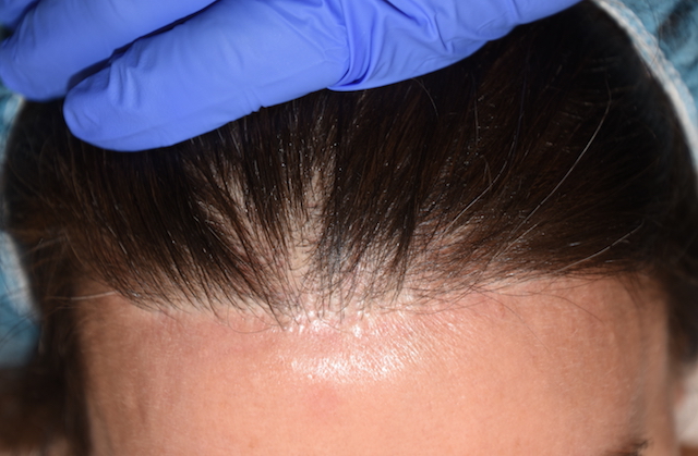 Scar Appearances After Frontal Hairline Advancement for Vertical ...