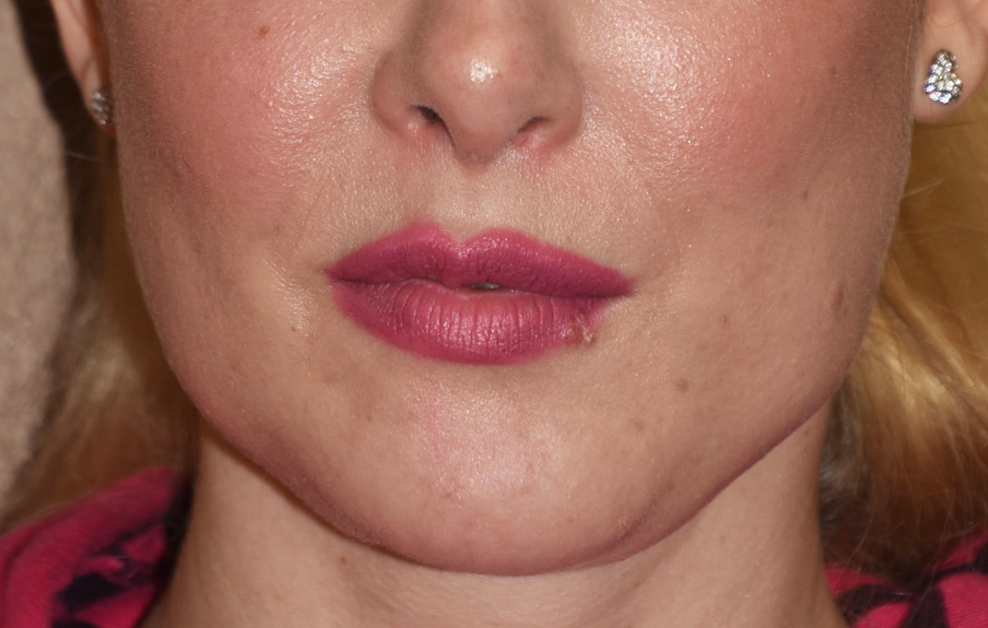 Plastic Surgery Case Study - Vertical Jaw Angle Lengthening and ...