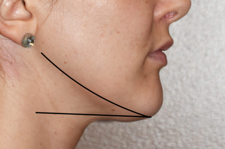 Plastic Surgery Case Study - Vertical Jaw Angle Lengthening and ...