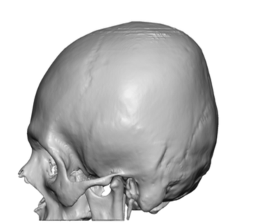 Plastic Surgery Case Study - Custom Skull Implant for Plagiocephalic ...