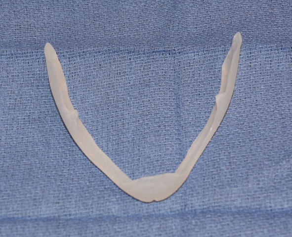 V Line Reversal Surgery Using Custom Jawline Implants - Explore Plastic ...