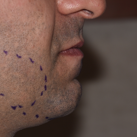 Plastic Surgery Case Study - Vertical Lengthening Chin Implant In a ...