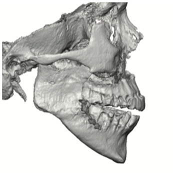 The Significance of the Antegonial Notch in Custom Jawline Implant ...
