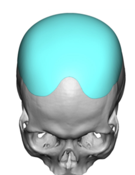 Custom skull implant design for inverted V shaped skull deformity top ...