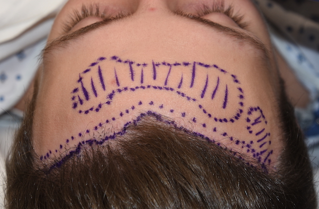 Plastic Surgery Case Study - Combined Frontal Hairline Advancement with ...