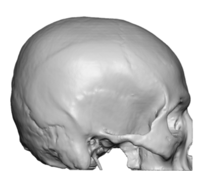 Inverted V shape skull deformity side view 3D CT scan Dr Barry Eppley ...