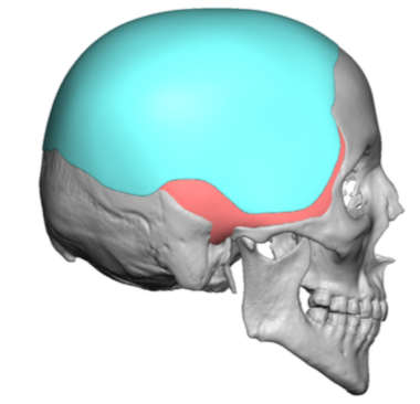 custom head widening implant design side view Dr Barry Eppley ...