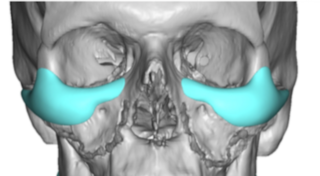 Custom Male Cheek Implant Styles for the High Cheekbone Look - Explore ...