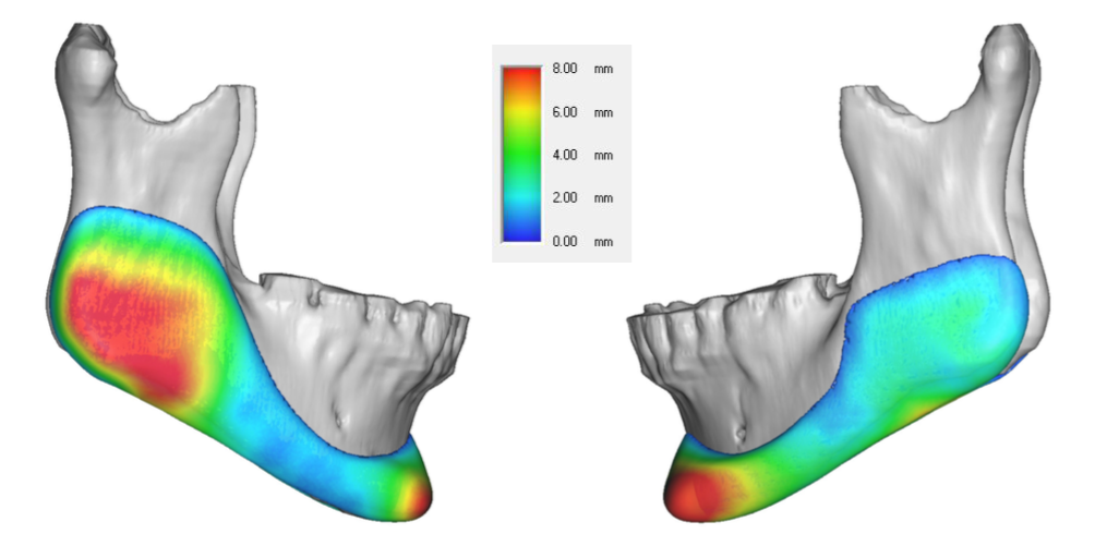 Plastic Surgery Case Study - Facial Asymmetry Correction with Custom ...