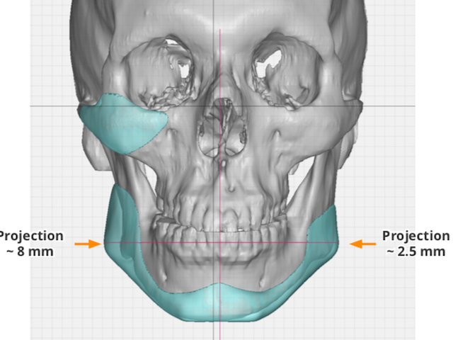 Plastic Surgery Case Study - Facial Asymmetry Correction with Custom ...