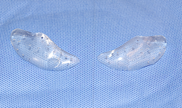 The Extended Infraorbital Implant Combined with Cheeklifts for MIdface ...