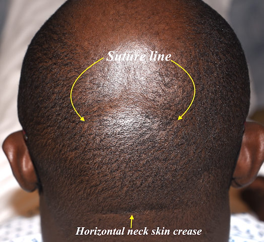 Reducing the Isolated Occipital Skull Bone Protrusion Deformity ...