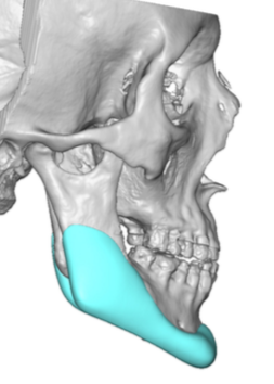 The Significance of the Antegonial Notch in Custom Jawline Implant ...