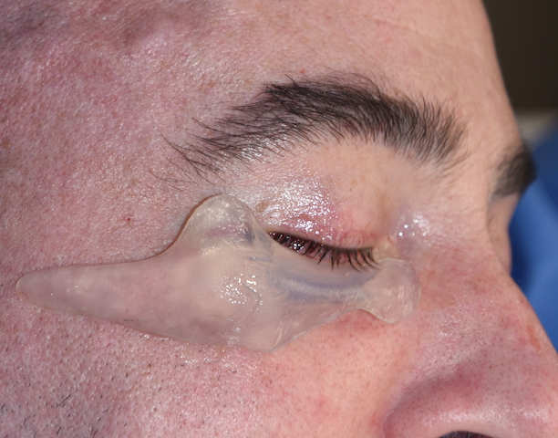 Plastic Surgery Case Study - Large Custom Infraorbital-Malar Implants ...