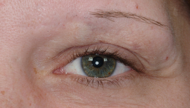 Plastic Surgery Case Study - Combined Eyebrow Scar Revision and Upper ...