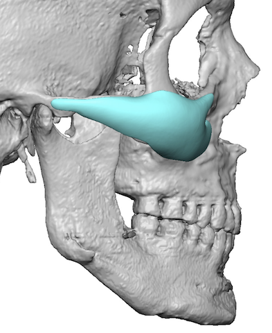 Custom Male Cheek Implant Styles for the High Cheekbone Look - Explore ...