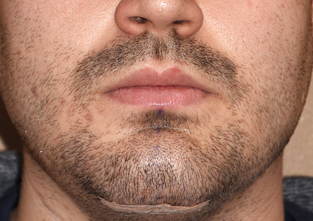 male custom square chin implant after front view Dr Barry Eppley ...