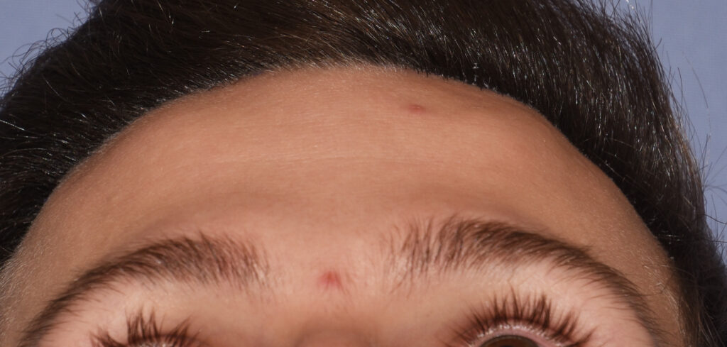 Plastic Surgery Case Study - Combined Frontal Hairline Advancement with ...