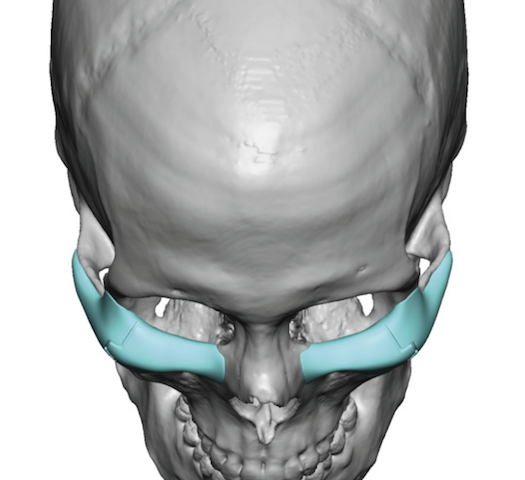 Plastic Surgery Case Study - Large Custom Infraorbital-Malar Implants ...