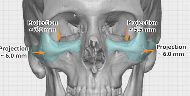 Plastic Surgery Case Study - Large Custom Infraorbital-Malar Implants ...