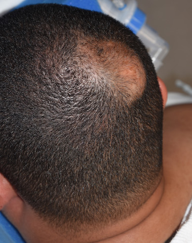 Plastic Surgery Case Study - Excision of Scalp Mass With Vertical Scalp ...