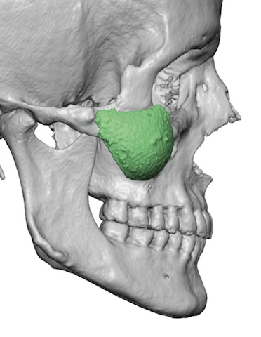 Custom Male Cheek Implant Styles for the High Cheekbone Look - Explore ...
