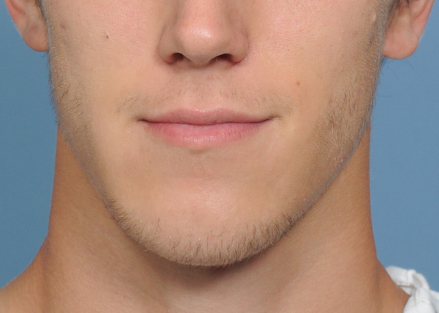 Plastic Surgery Case Study - Long Term Outcome in Male Intraoral ...