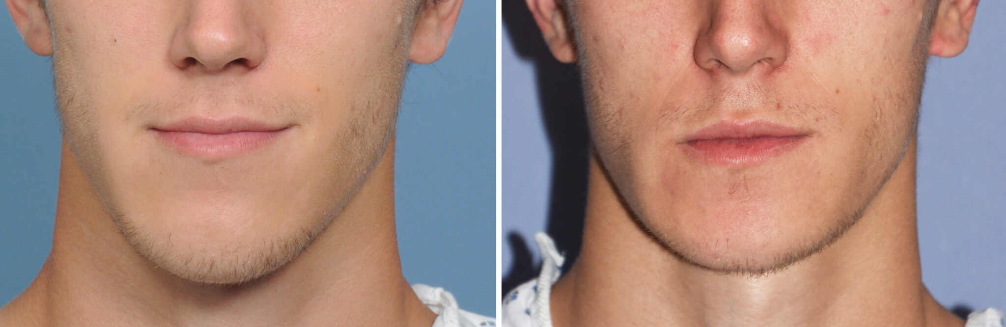 male vertical chin reduction results front view Dr Barry Eppley ...