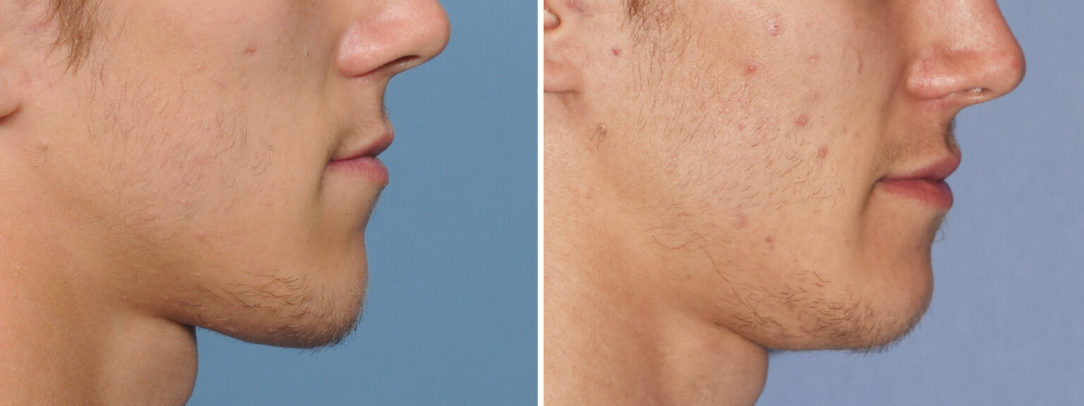 male vertical chin reduction results side view Dr Barry Eppley ...