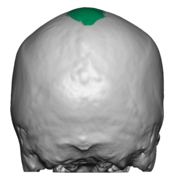 Plastic Surgery Case Study - Custom Skull Implant and Sagittal Crest ...