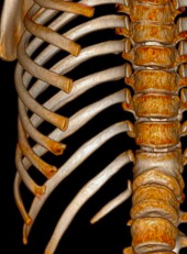 3D CT scan of lower rib cage Dr Barry Eppley Indianapolis - Explore ...