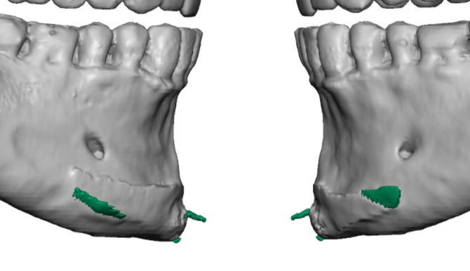 chin implant bony overgrowths 3d CT scan side view DR Barry Eppley ...