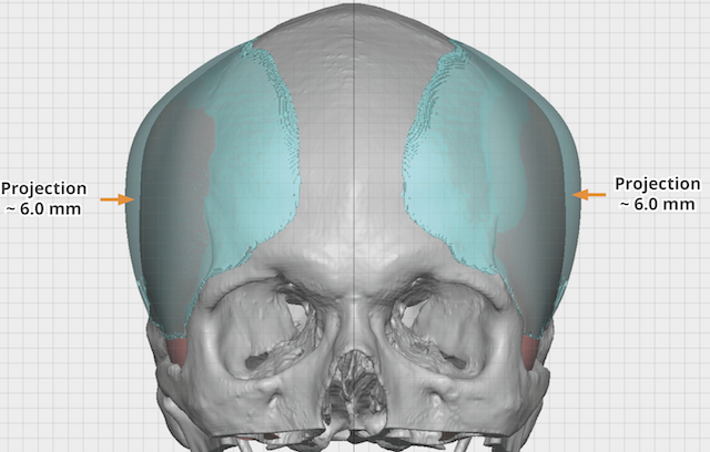 Plastic Surgery Case Study - Custom Forehead-Temporal Head Widening ...