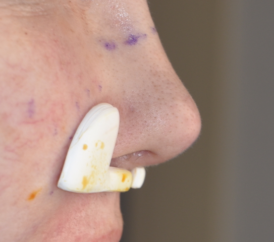 ePTFE Premaxillary and Paranasal Implants for Central Midface ...