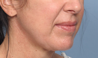 The Role of the Jowl Tuck Up Facelift in the Younger Patient - Explore ...