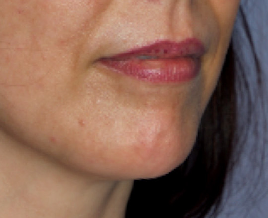 female chin reshaping oblique after DR Barry Eppley Indianapolis ...