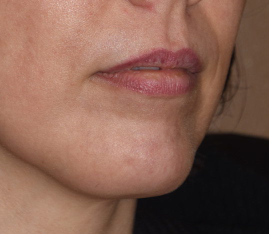 female chin reshaping oblique before Dr Barry Eppley Indianapolis ...