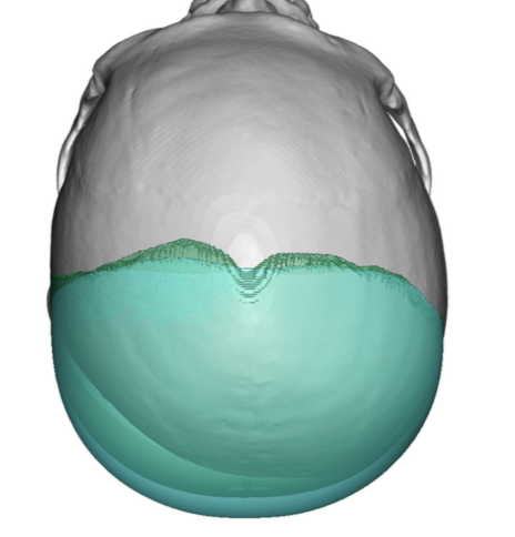 Plastic Surgery Case Study - Secondary Custom Skull Implant Replacement ...